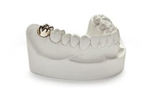 Dental Crowns Lab Gold Full Cast | DDS Lab