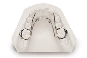 Space Maintainers, Regainers, and Bite Plates | DDS Dental Lab