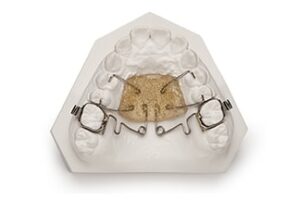 Orthodontics Laboratory - Molar Distalizing | DDS Lab