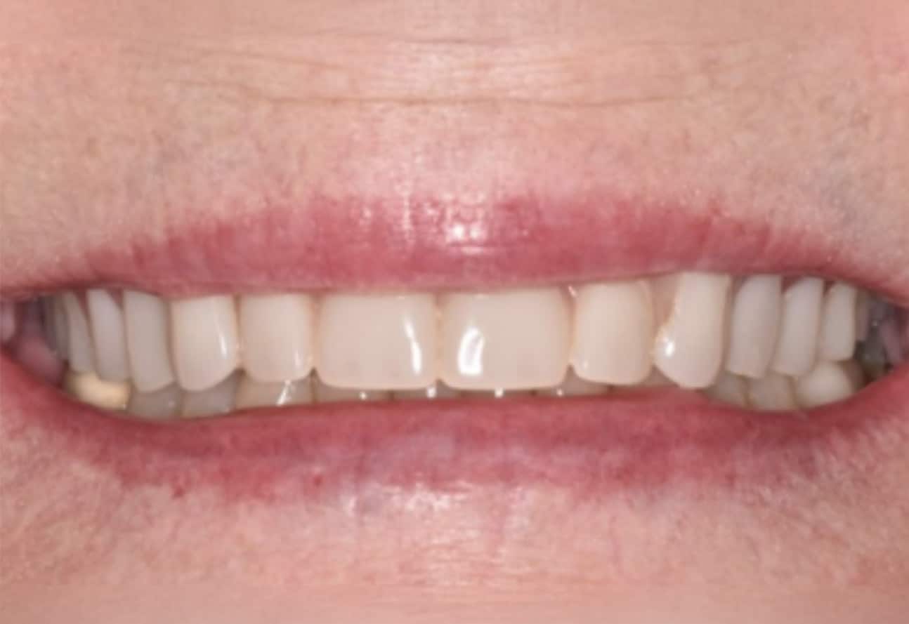 3D Printed Digital Denture Workflow